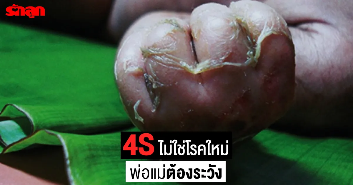 4S ไม่ใช่โรคใหม่ พ่อแม่ต้องระวัง