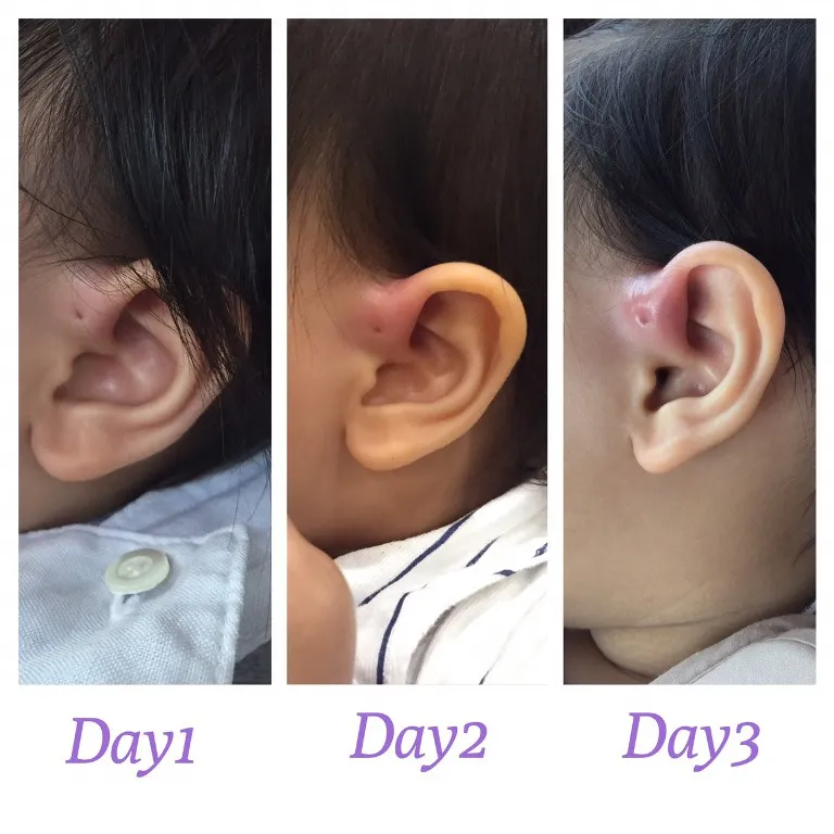 Ear pit อักเสบ ภัยเงียบของเด็กมีรูเล็ก ๆ ข้างหู